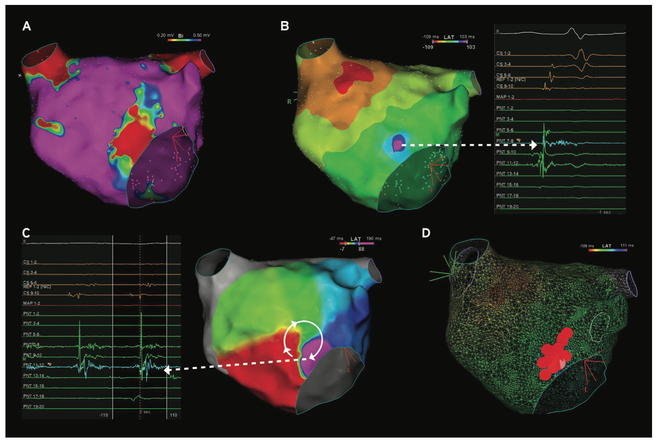 Functional Substrate Mapping Under Sinus Rhythm Predicts Critical Isthmus Of Atrial Tachycardia